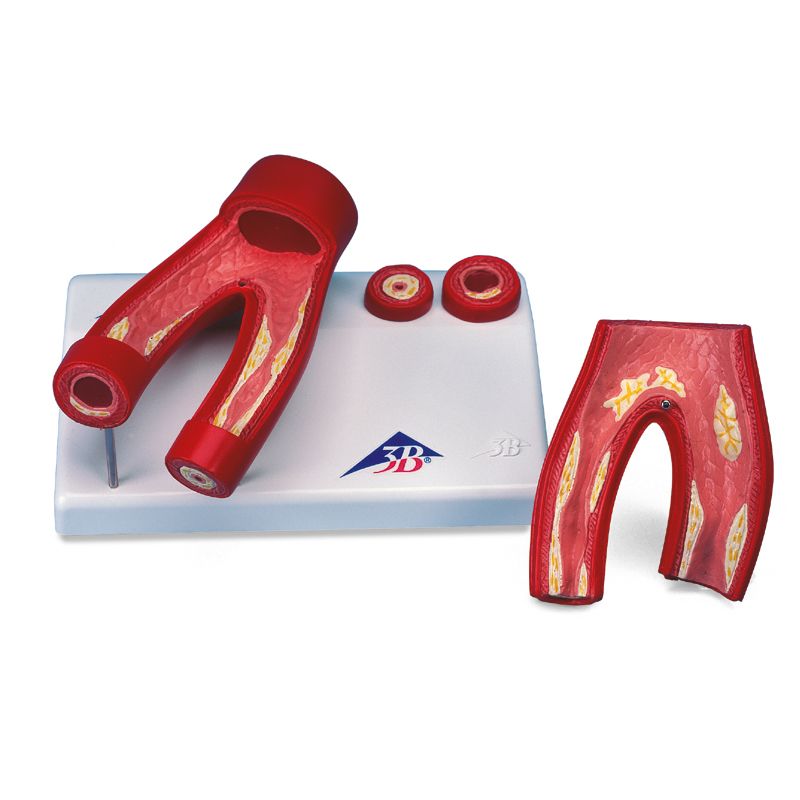 Arteriosclerosis Model with Cross-Section of Artery - LabWorld.co.uk
